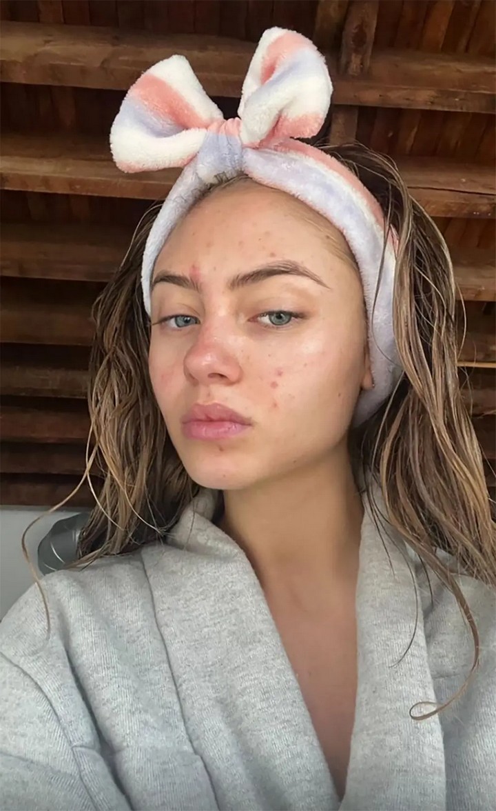 Leni Klum Shows Face Full of Blemishes in Makeup-Free Selfie