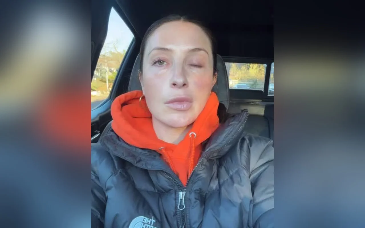 Bristol Palin Shows Her Drooping Face Amid Struggle With Facial Paralysis